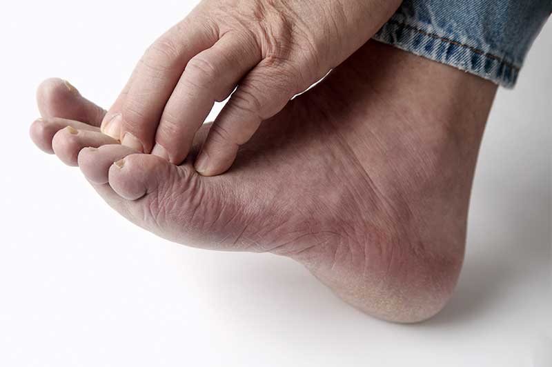 Foot Arthritis